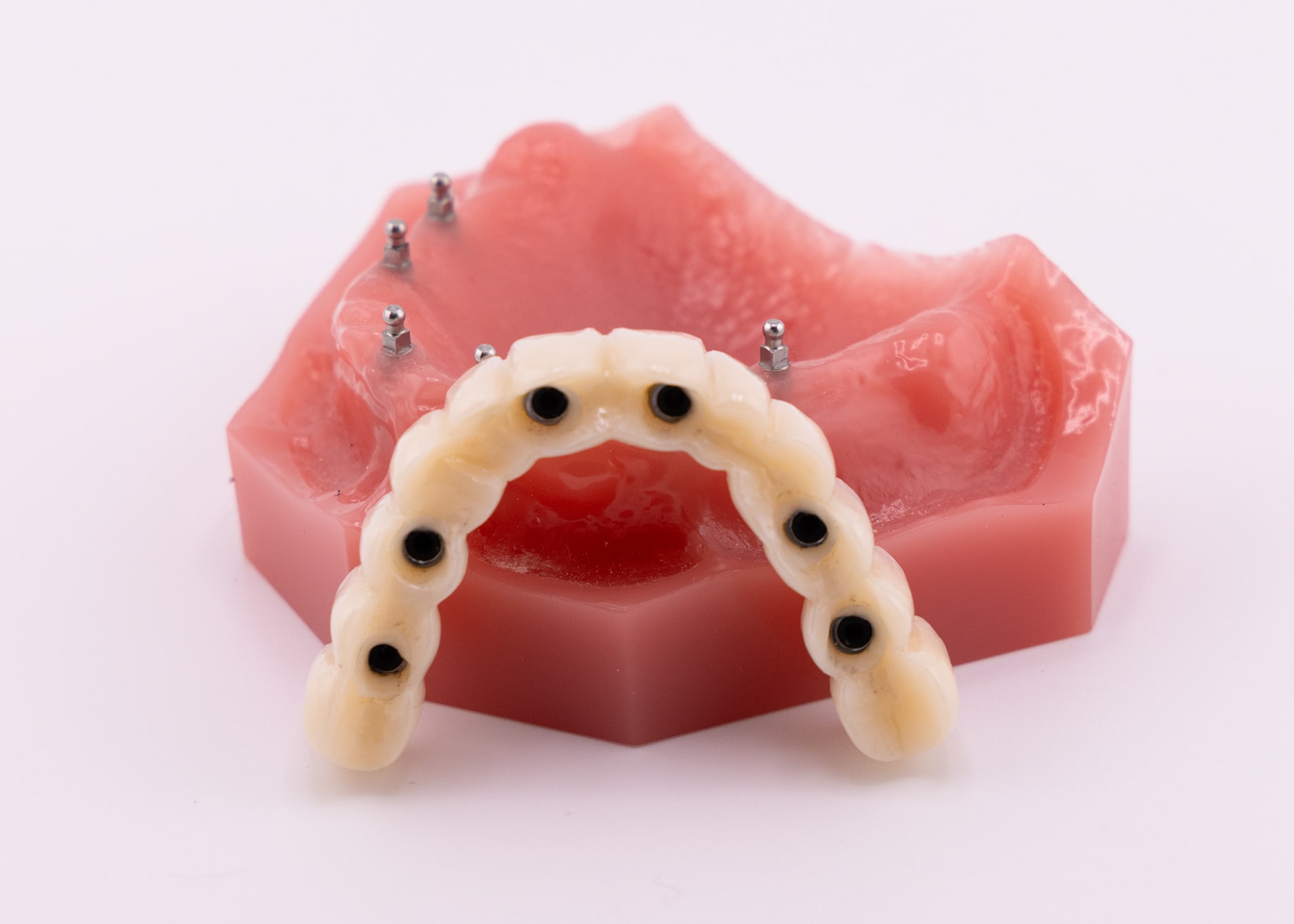 What Is a Roundhouse Bridge? | Implant Bridges in Sonora, CA