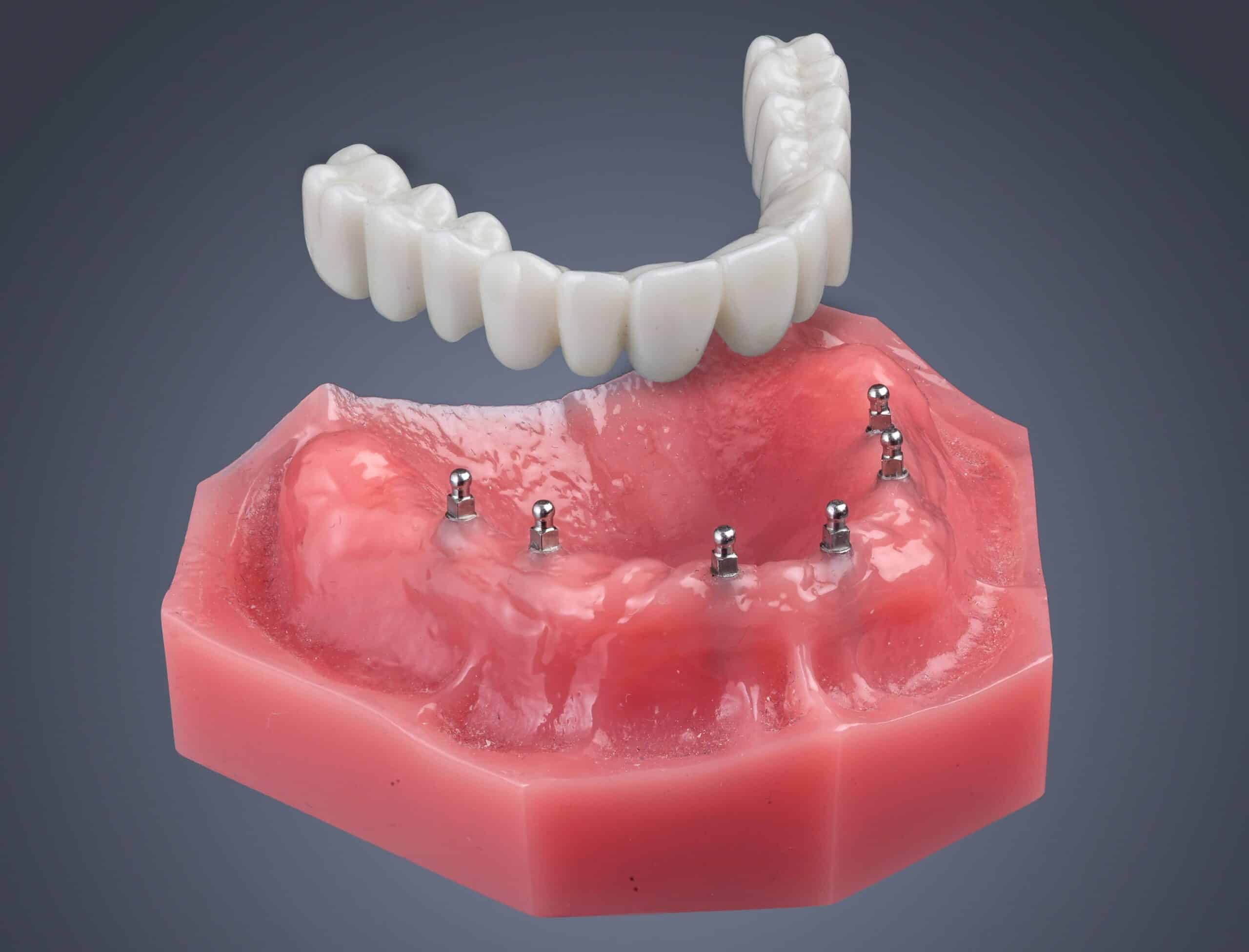 Understanding the Implant Denture Process | Paul Berger, DDS