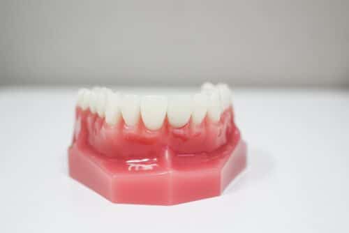 What Is a Fixed Restoration? | Implant Dentures in Sonora, CA